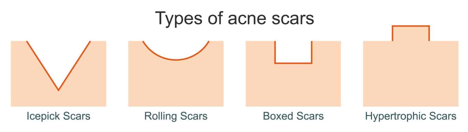 How To Get Rid of Atrophic Acne Scars [Realistic Ways] - Hello Mia Wilson