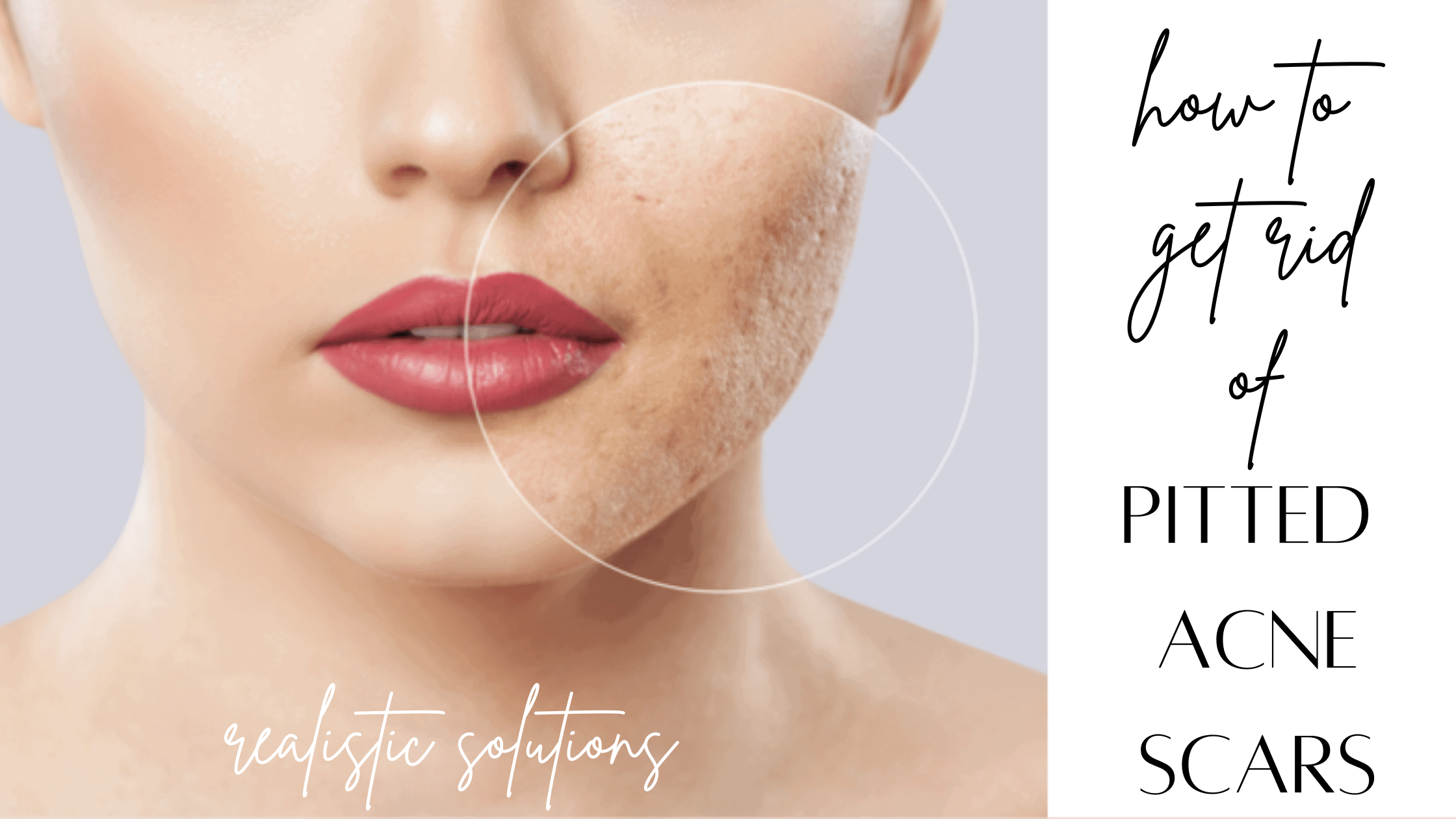 How To Get Rid Of Pitted Acne Scars