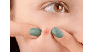 What Is A Blind Pimple? How To Get Rid Of Them Fast [5 Ways] - Hello ...