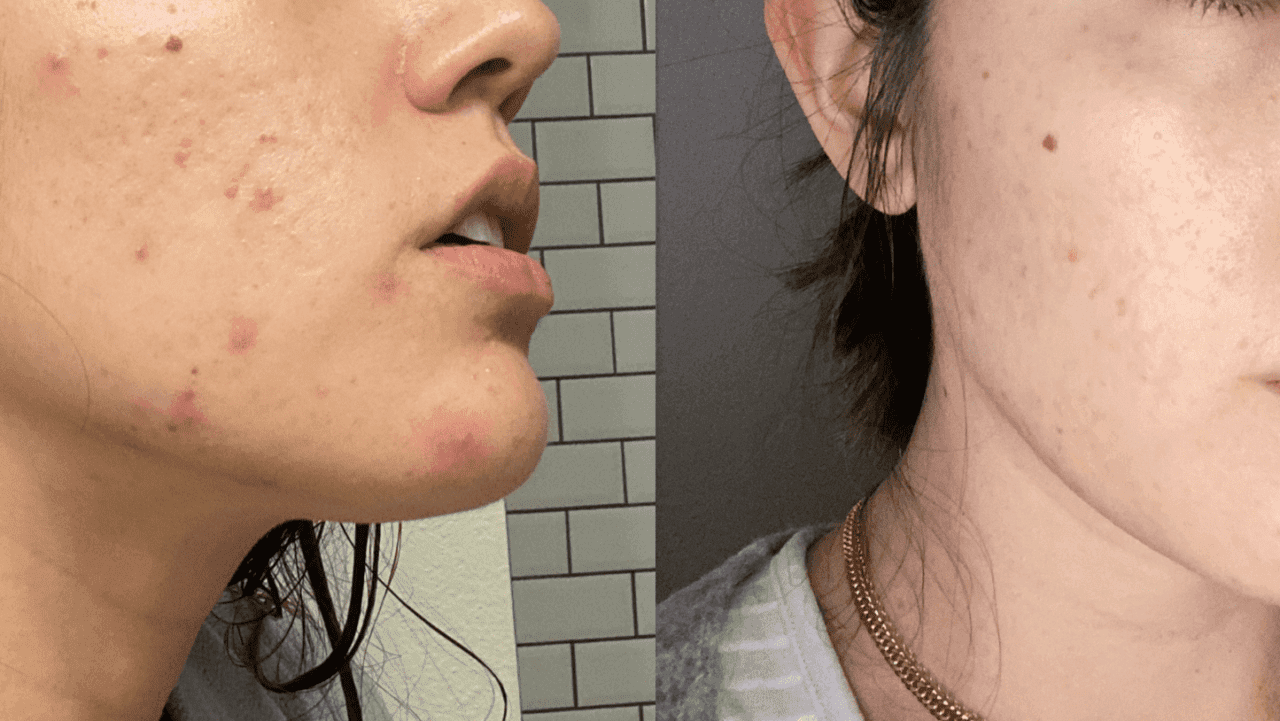 How To Affordably Treat Pregnancy Acne: [3 Pregnancy and Acne Safe ...